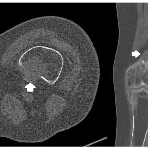 Knee Ct Scan A 282624 Mm Lobulated Lytic Mass In Posteromedial Download Scientific Diagram