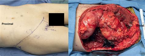 Right External Hemipelvectomy And Hemisacrectomy Resulted In A 45 Â 20 Download Scientific