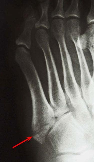 3rd Metatarsal Fracture Healing Time Toe And Forefoot Fractures