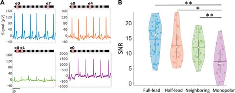Cardiac Sensing At A Spinal Cord Stimulation Lead A Promising On