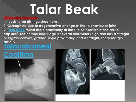 Talar Beak Radiology Classroom Facebook