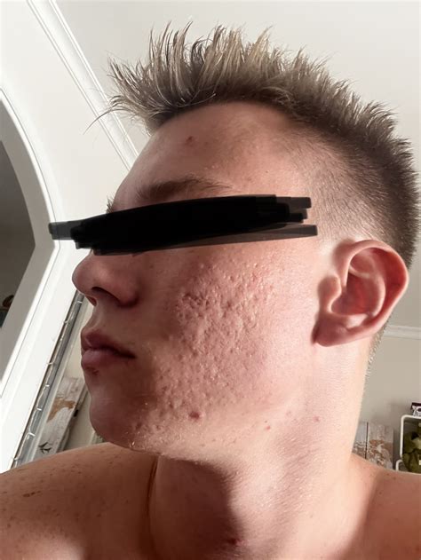 Severe Acne Scarring What Treatments Do I Need Scar Treatments