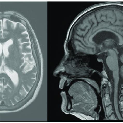 Mri Of The Head Revealed No Pathologic Findings Or Evidence Of Metastasis Download Scientific