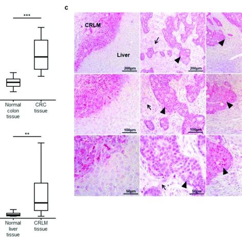 Postoperative Osteopontin Serum Levels Are Associated With The