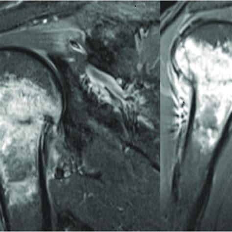 Pdf Case Report Of A Surgical Neck Humerus Fracture Due To Strength