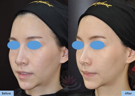 💓filler Midface ยกแก้ม And เติมเต็มร่องแก้ม 💓 🧡 Midface คือ จุดรอยต่อของ