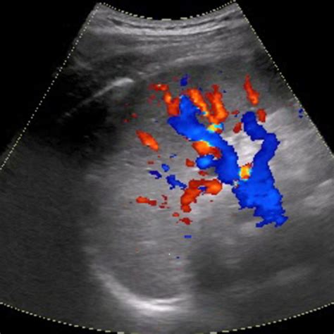 Spleen Ultrasound