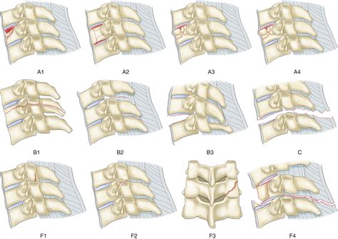 Subaxial Cervical Spine Injuries Clinical Tree