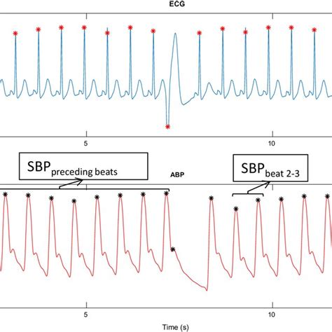 Example Of The Post Extrasystolic Abp Waveform Morphology For A Patient