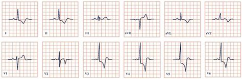 Broad Electrocardiogram Syndromes Spectrum From Common Emergencies To Particular Electrical