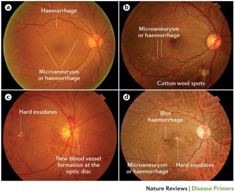 Fundoscopic Exam
