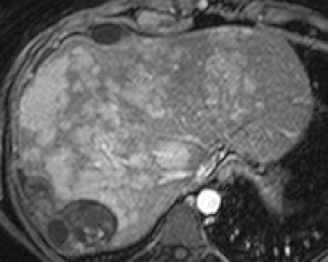 Liver Atlas Diagnosis Metastasis Gastrointestinal Stromal Tumor Gist