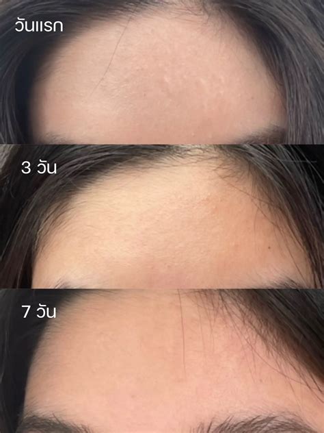 7วันกับกรักษาสิวผดบนหน้าผาก⚠️ ด้วยโฟมที่เคลมว่ารักษาสิวได้จริง‼️ แกล