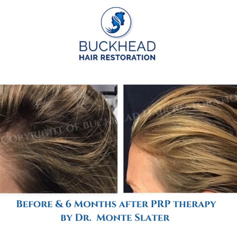 Update More Than 143 Best Hair Treatment In Trivandrum Ceg Edu Vn