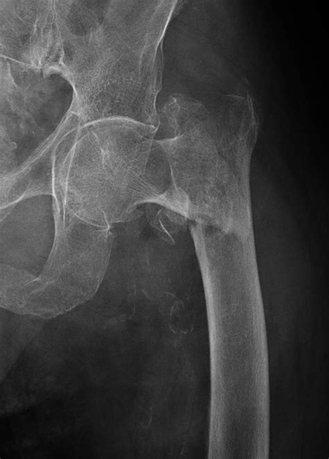 Fracture Du Col Du Fémur à Lyon Chirurgie De La Hanche