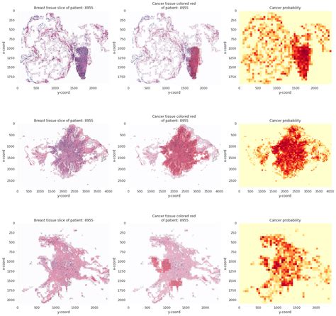 Did I Just Succeed In Detecting Breast Cancer From A Single Image With Python And Machine