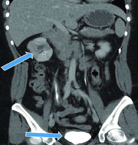 Contrast Enhanced Ct Urography Scan July 2012 Showing A Thickened