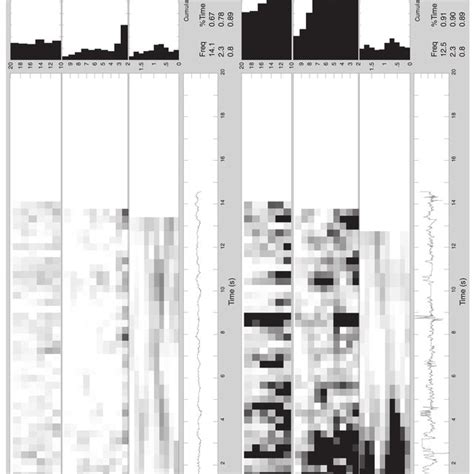 Modified Fitzpatrick Wrinkle Grading Scale Grade 0 Absence Of