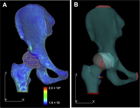 Effect Of Sagittal Pelvic Tilt On Joint Stress Distribution In Hip Dysplasia A Finite Element
