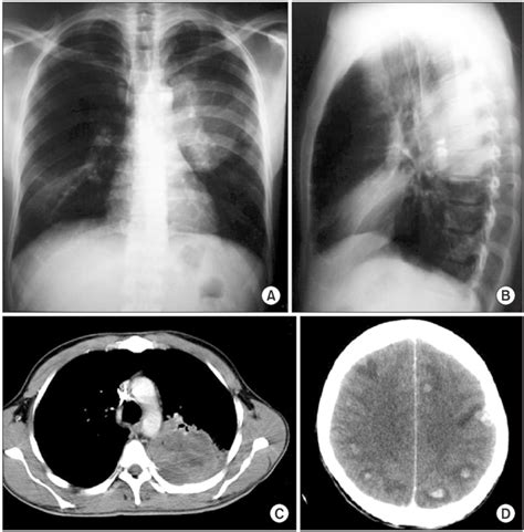 Chest Radiographs And Chest And Skull Computed Tomography Ct Scans Of