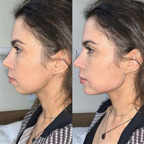 Jawline Nedir Ve Jawline Nasıl Yapılır Jawline Dolgusu Geçici Midir
