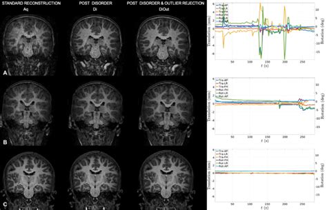 three individual cases of mprage images before and after motion