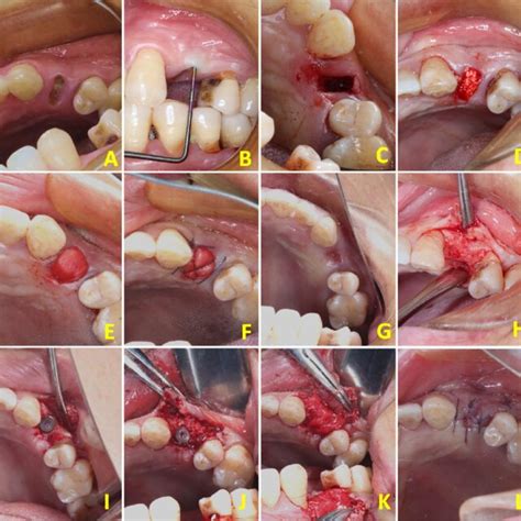 Intra Oral Photographs Of Socket Preservation And Dental Implant