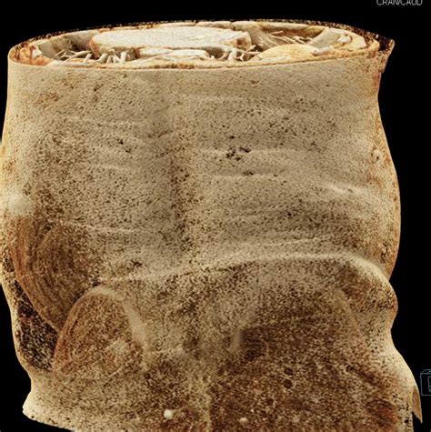 Vascular Mapping With Cinematic Rendering Vascular Radiology Case