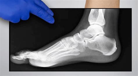 Normal X Rays Normal Feet Advanced Foot Care Of Nj Llc