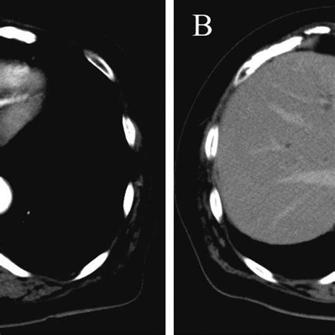 Abdominal Contrast Enhanced Computed Tomography A Lesion Measuring 20
