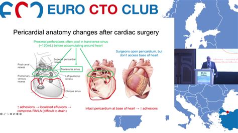 16th Experts Live CTO Flash Highlights Post CABG CTOs Anatomical