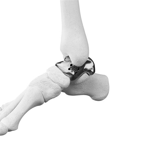 Restor3d Total Talus Valor Medical