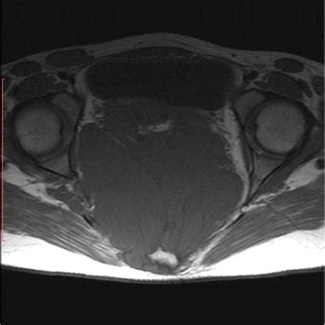 Axial T 1 Weighted Images Showing A Hypointense Mass Lesion With Linear Download Scientific