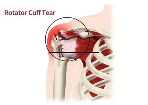 Rotator Cuff Repair With Augmentation Rotator Cuff Tear Treatment