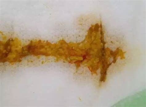 关于宝宝便便最强贴绿便泡沫便血丝便奶瓣便蛋花水样便