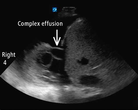 Figure 0315699 Right Sided Pleural Effusion With Multiple Thick