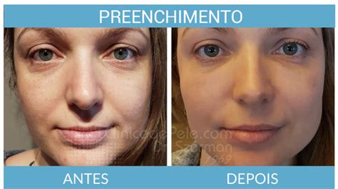 Preenchimento Com ácido Hialurônico Clinica De Pele 2025