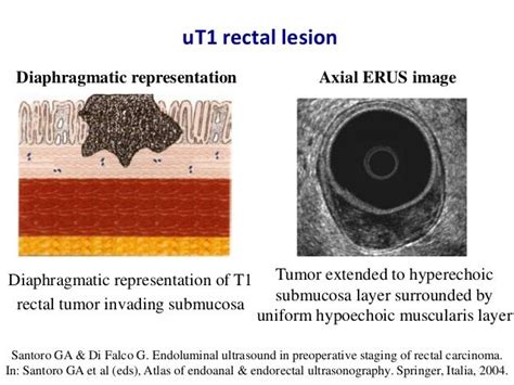 Endorectal Ultrasound In Rectal Diseases