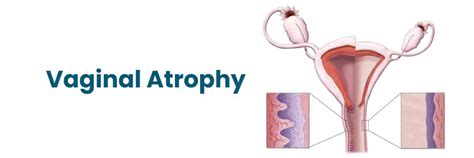 Atrophy Menopause Symptoms