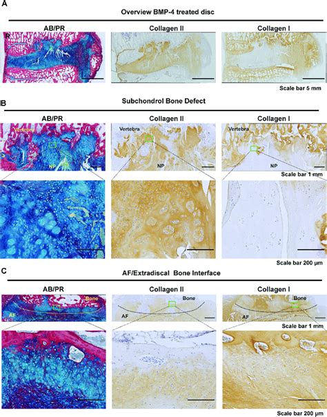 The Overview And The Area Of Subchondral Bone Defect And Extradiscal