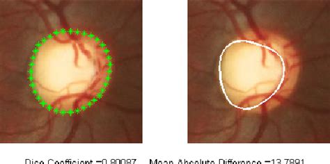 Figure 5 From Automatic Extraction Of The Optic Disc Boundary For