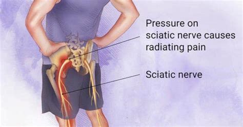 Pressure Point Behind Knee For Sciatica
