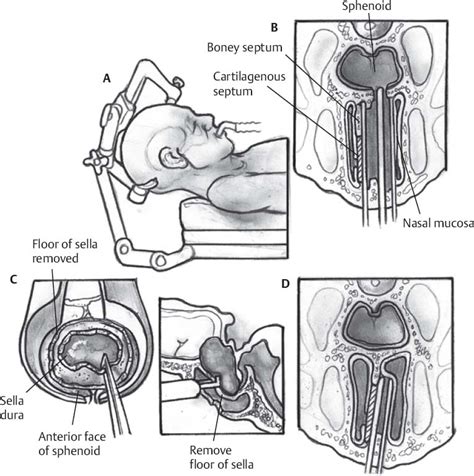 Transsphenoidal Approach Neupsy Key