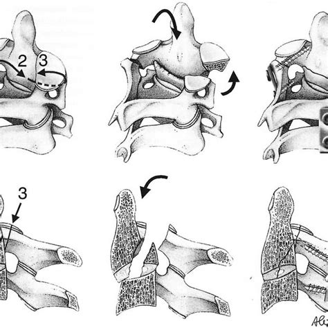 Diagram Showing The Roy Camille Classification For Fractures Of The Download Scientific Diagram