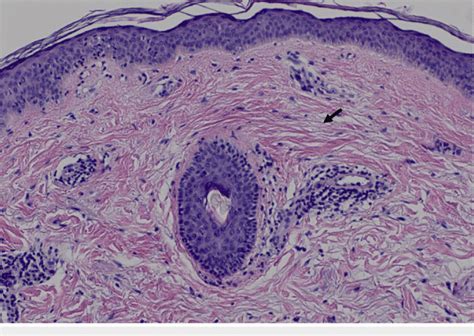 A Close Up View Of A Superficial Dermal Layer From Figure 2 Diffuse