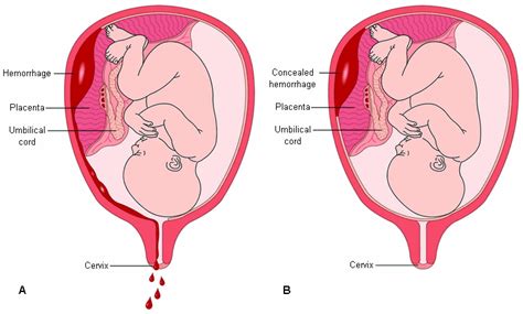 Placental Abruption Symptoms Diagnosis And Treatment Bmj Best Practice