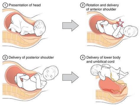 Shoulder Dystocia Medizzy