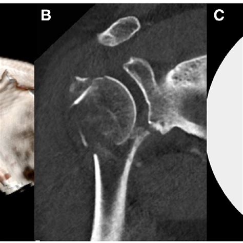 Pdf Current Concepts In Locking Plate Fixation Of Proximal Humerus Fractures