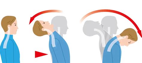 Whiplash Car Accident What To Do Next For Compensation