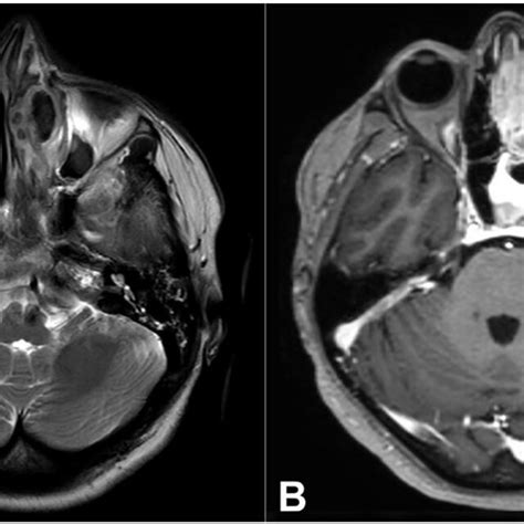 Mri Imaging Showed A Heterogeneous Mass On T2w1 B Hemosinus Was